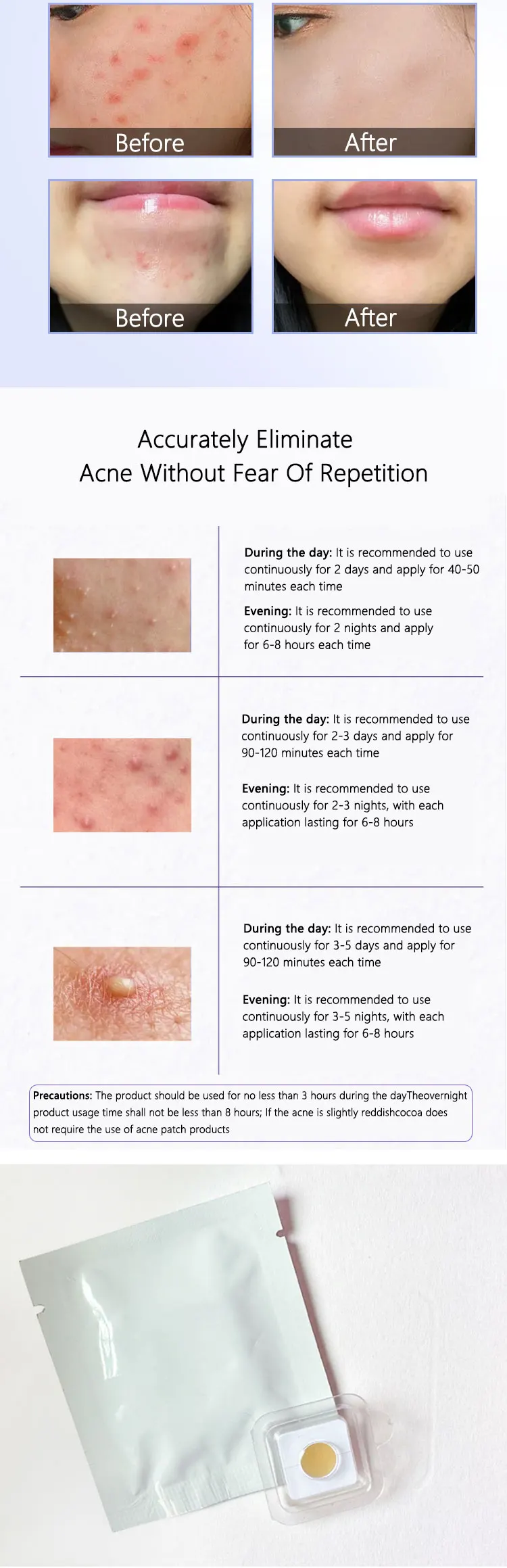 OEM Hydrocolloid Microneedle Patch for Early Stage Acne Skin Care Spot ...