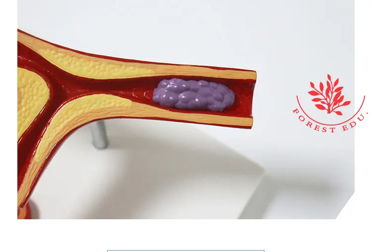 Artery and Blood Vessel Model - Understanding Atherosclerosis