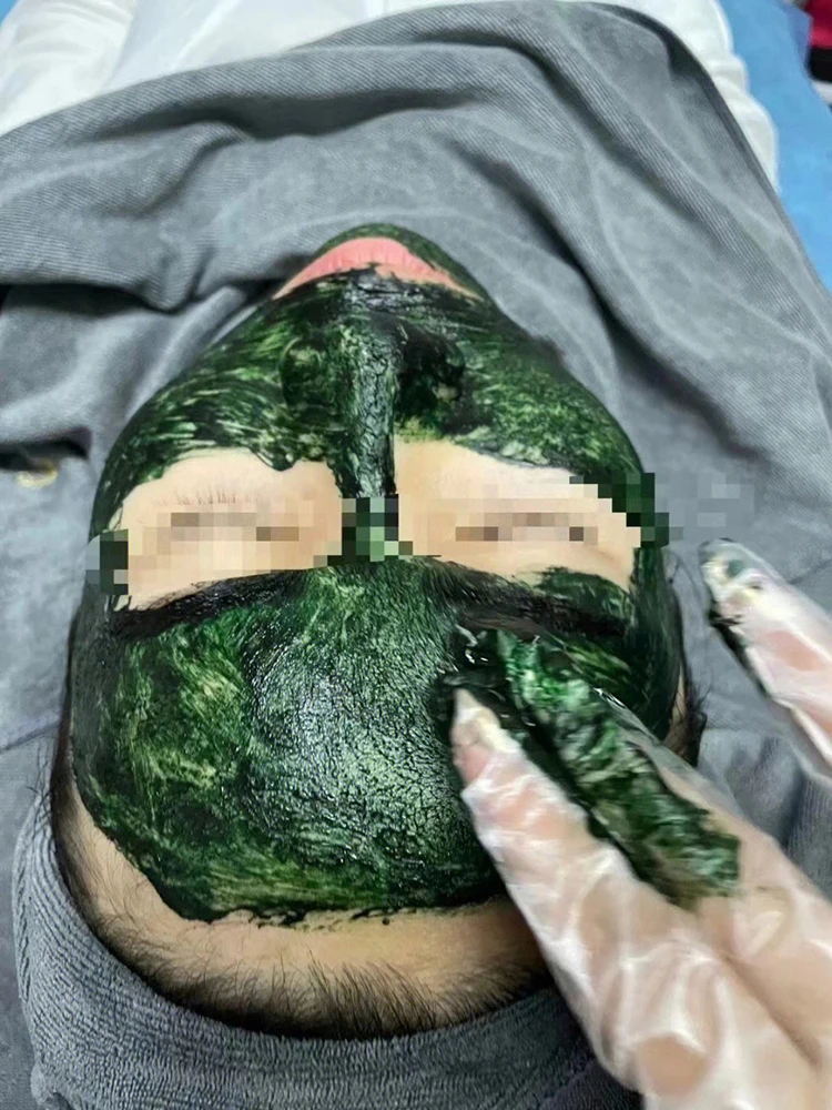 OEM Spongilla Spicules Microneedling Therapy Acne Removal Algae Peeling ...