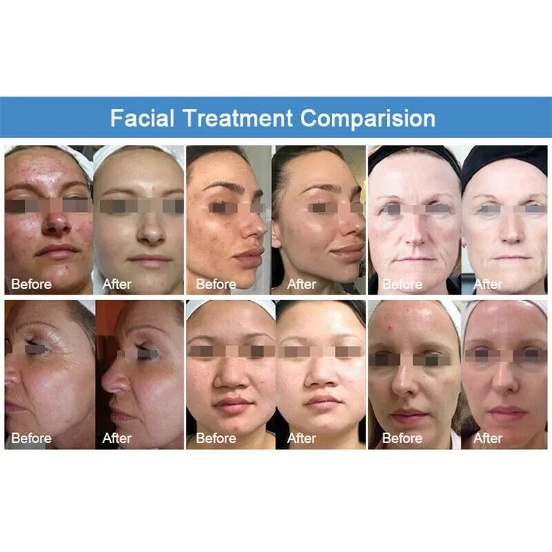 2023 Newest Korea O2 to Derm Pure Oxygen O2derm Oxygen Facial Mask ...