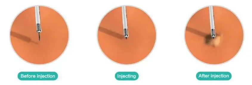 Digestive Tract Disposable Endoscope Injection Needles Gastrointestinal ...