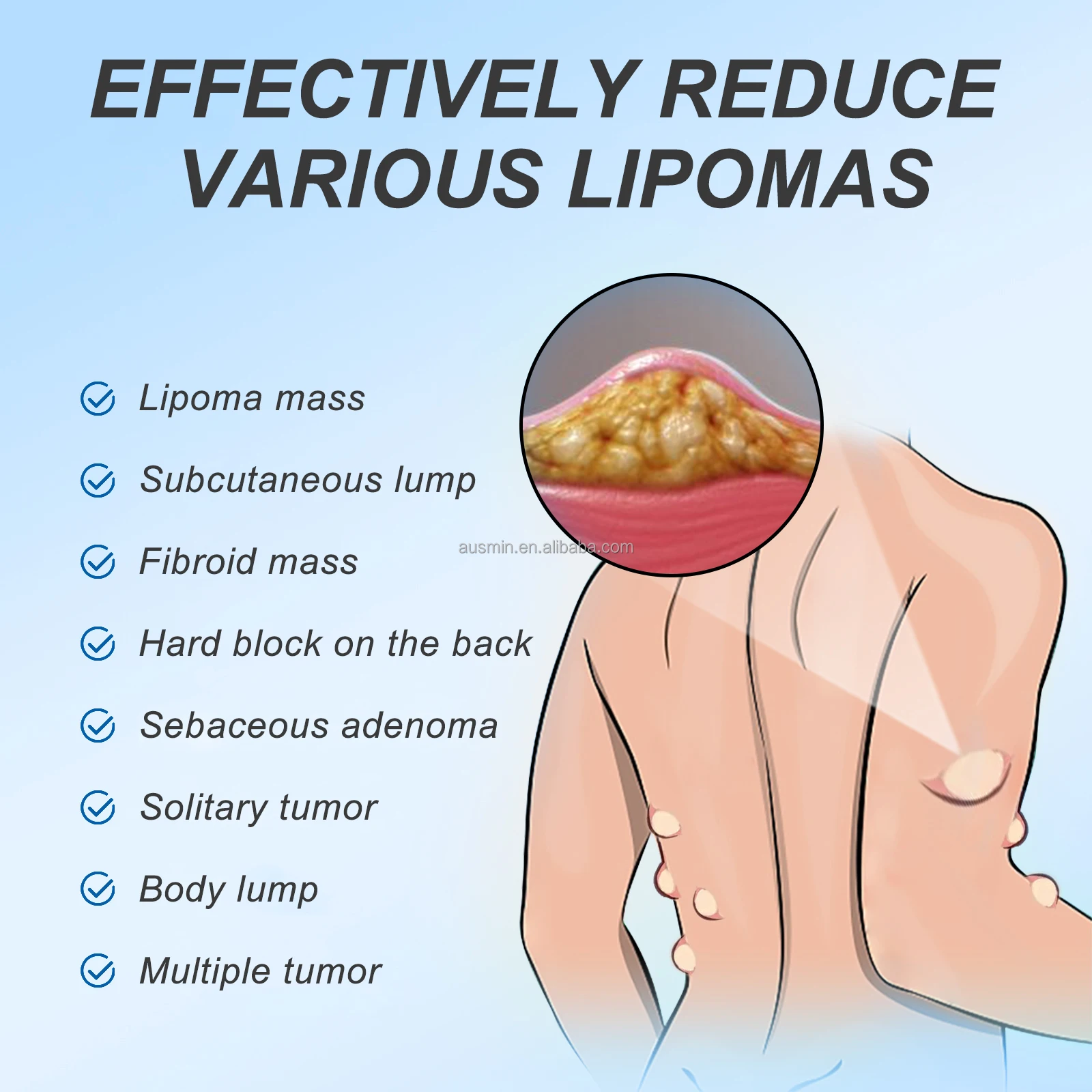 Lipoma Ointment Effectively Removal Lipoma Fibroids Body Cream ...