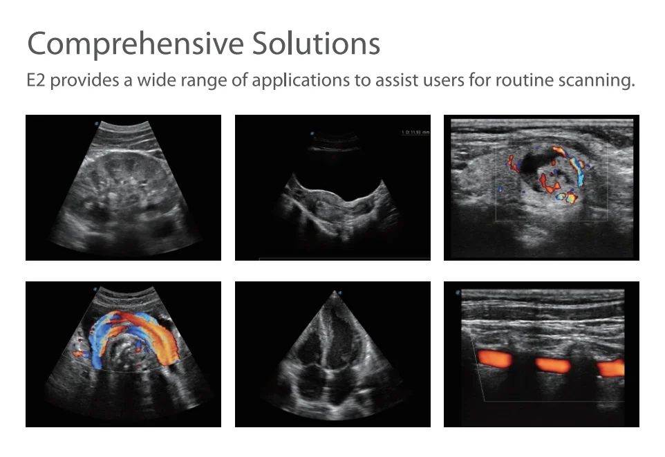 Sonoscape E2 3D 4D Ultrasound - Advanced OB/GYN Diagnostics