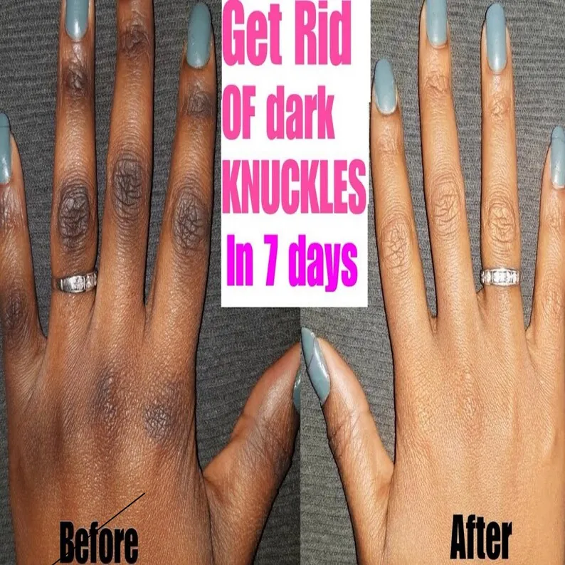 Get Rid of Dark Knuckles in 7 Days - Whitening Serum for Hands, Elbows ...
