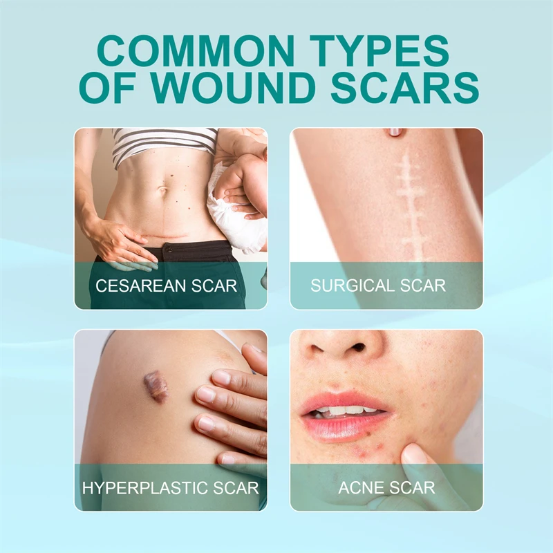 South Moon Scar Spray for Stretch Marks, Keloids, and Surgical Scars ...