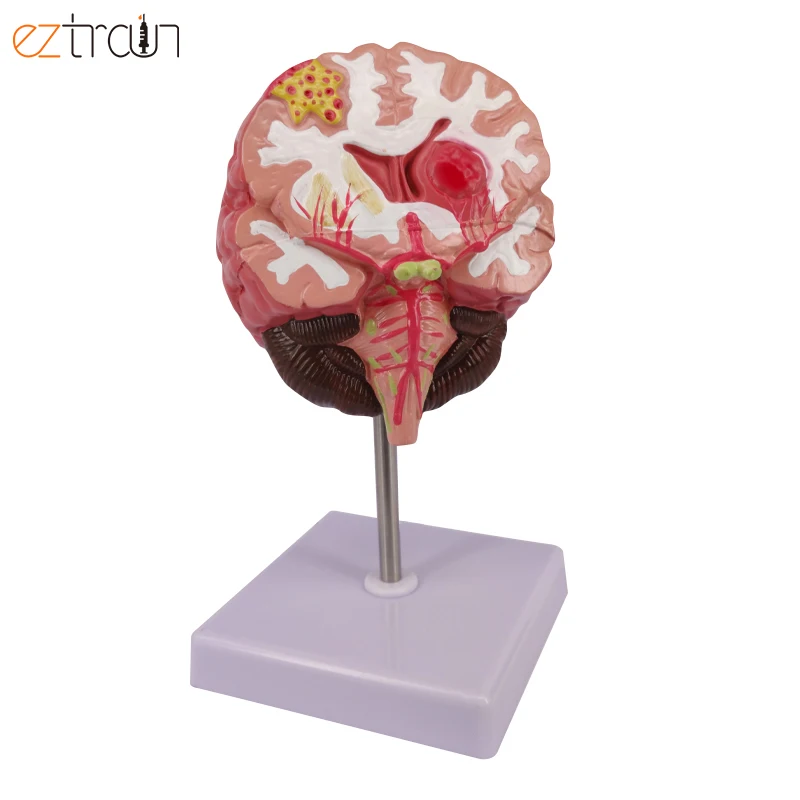 Human Brain Anatomy Model with Pathologies, Stroke,Subdural hematoma ...