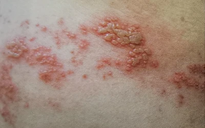 Photodiagnosis System For Skin Analysis And Vitiligo Detection