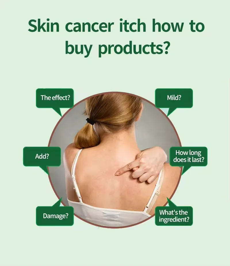 Hot Selling Fungal Infection Skin Psoriasis Creams Dermatitis Eczema Ointment Psoriasis Cream ...