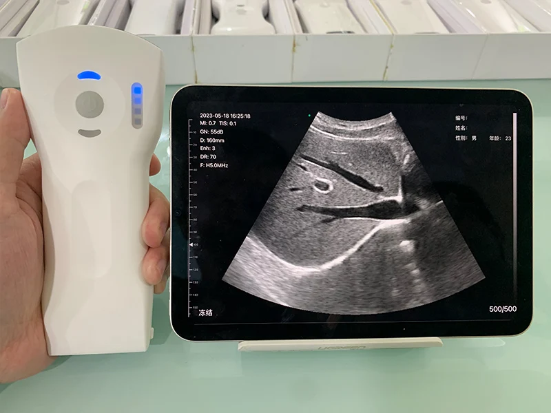 Suresult Wireless Transvaginal Ultrasound Probe - Konted C10 Android
