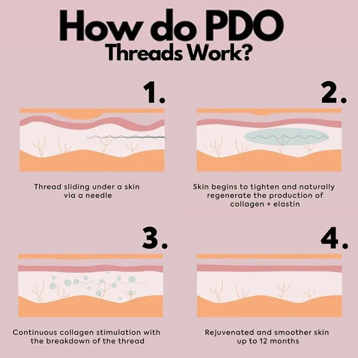 Korea 2024 Most Popular Mono 26g V Line Pdo Lifting Thread For Face ...