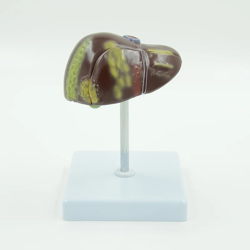 Human Liver Pathological Model Liver Disease Anatomical Model For ...