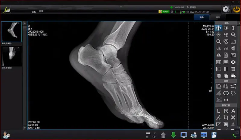 Digital Flat Plate Detector X-ray Venu 1717x Wired Digital Xray Dr Flat ...