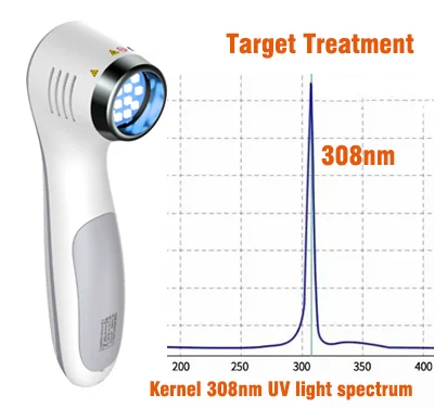 High Intensity 308nm Excimer Laser for Vitiligo & Psoriasis