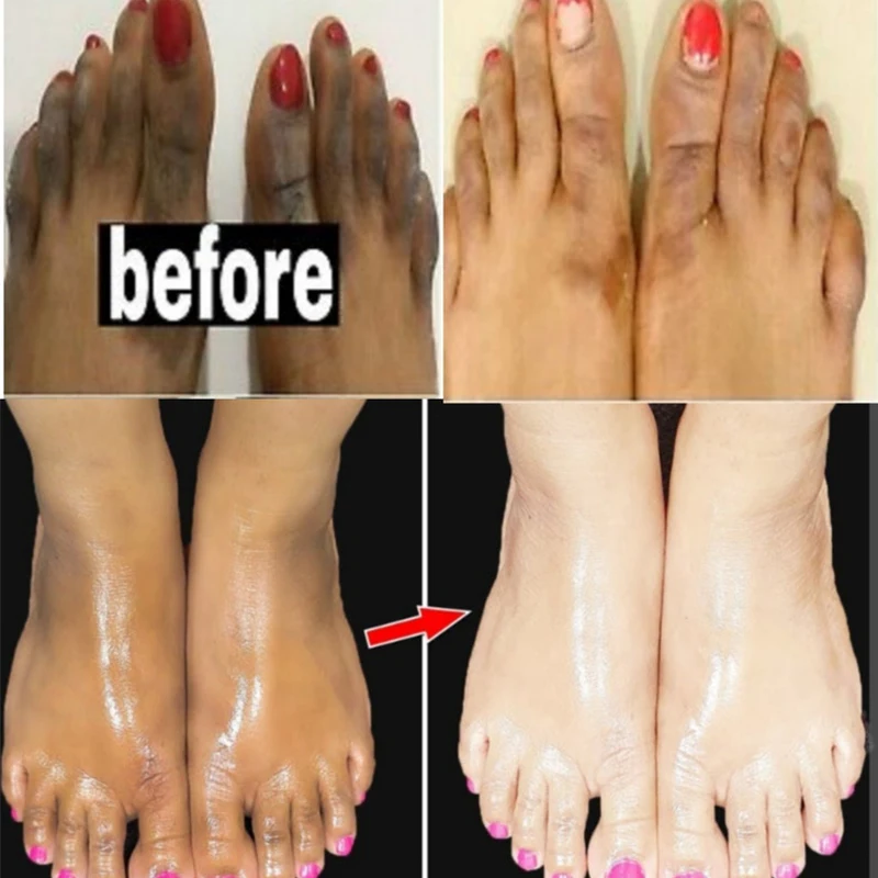 Intense Brightening Feet Knee Elbows Scrub -Effective Whitening Body Scrub