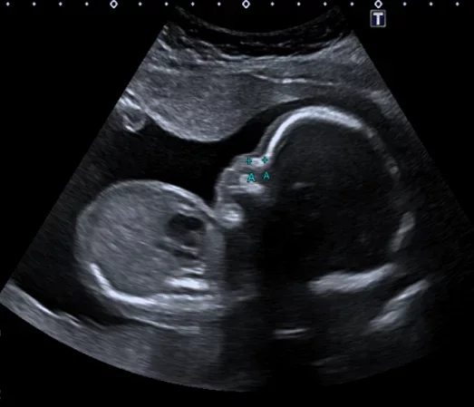 20-Week Anatomy Scan Are Ultrasound Scans That Are Used to Identify ...