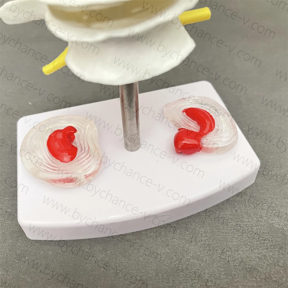 Pharmaceutical Factory Display Props Two-section Lumbar Spine Lesion ...