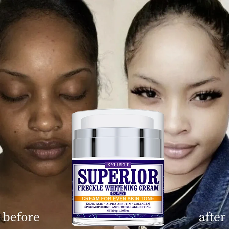 Superior Freckle 4k Plus Cream With Alpha Arbutin Dark Spot Removing ...