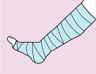 Eczema, Lymphedema Venous, Leg Ulcers Flexible Unna Boot Bandage with ...