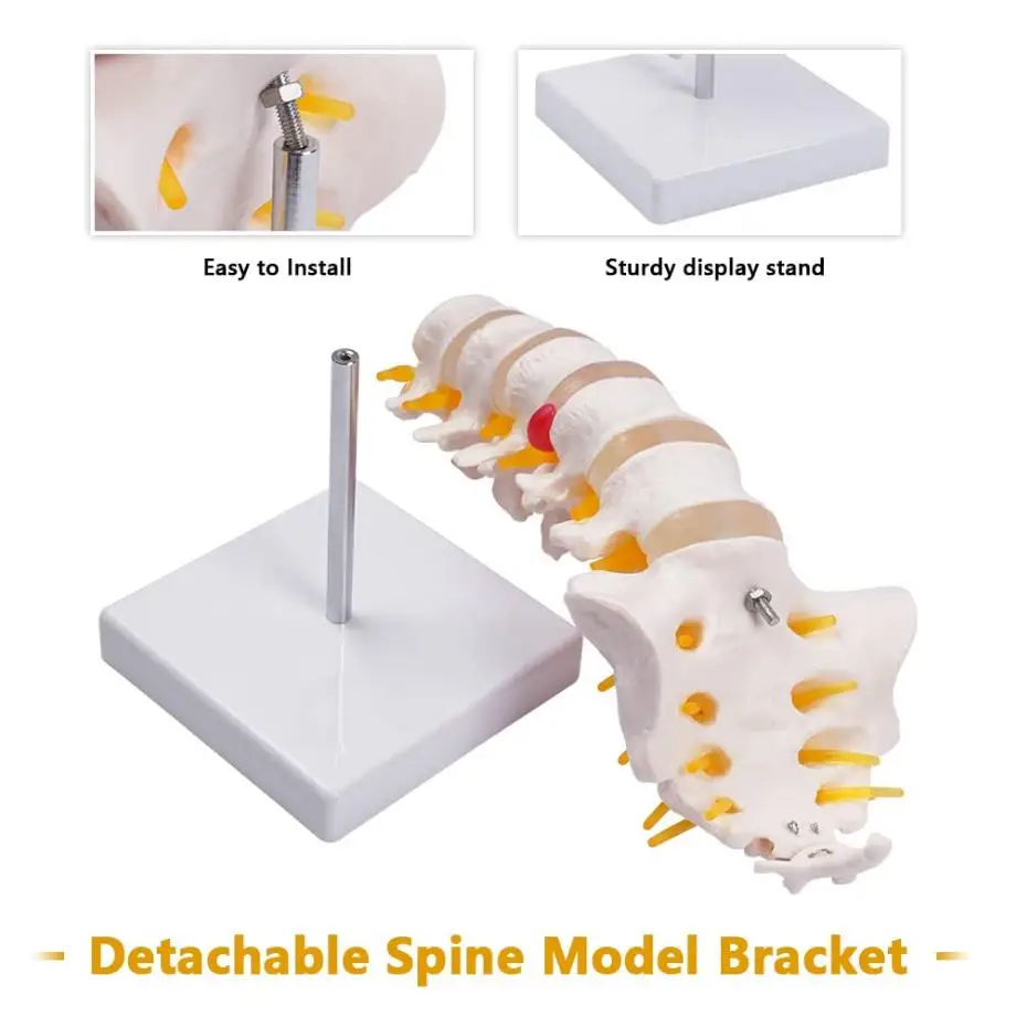 Medical Teaching Lumbar Vertebrae with Sacrum & Coccyx and Herniated ...