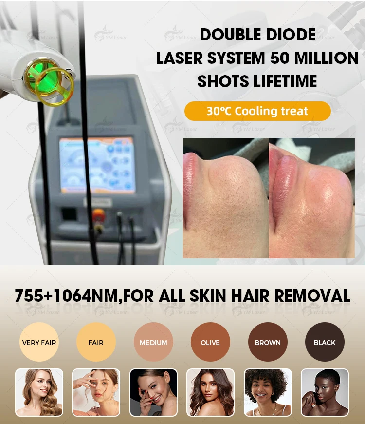 2023 Hot Sale 50 Millions Alexandrite Laser 1064nm 755nm Laser Hair ...
