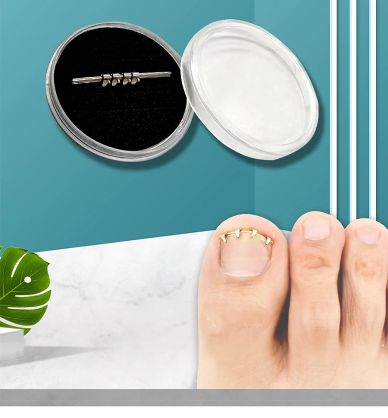 Ingrown Nail Hooktoenail Corrector Orthotic Nail Fixer Toenail ...