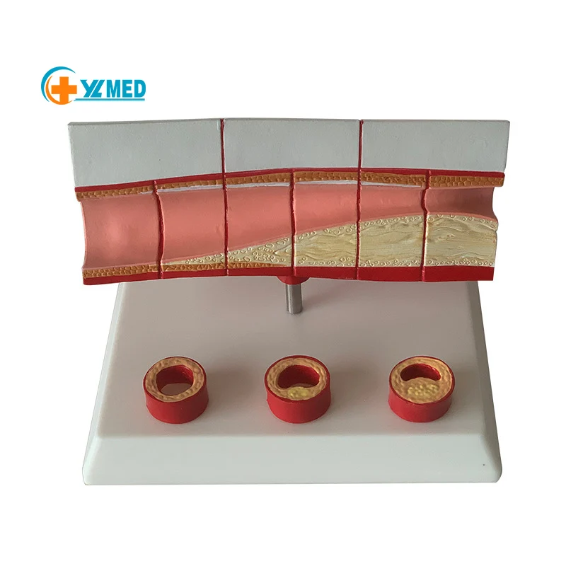 Anatomical Medical Science Human Vascular Lesions Demonstration Model ...