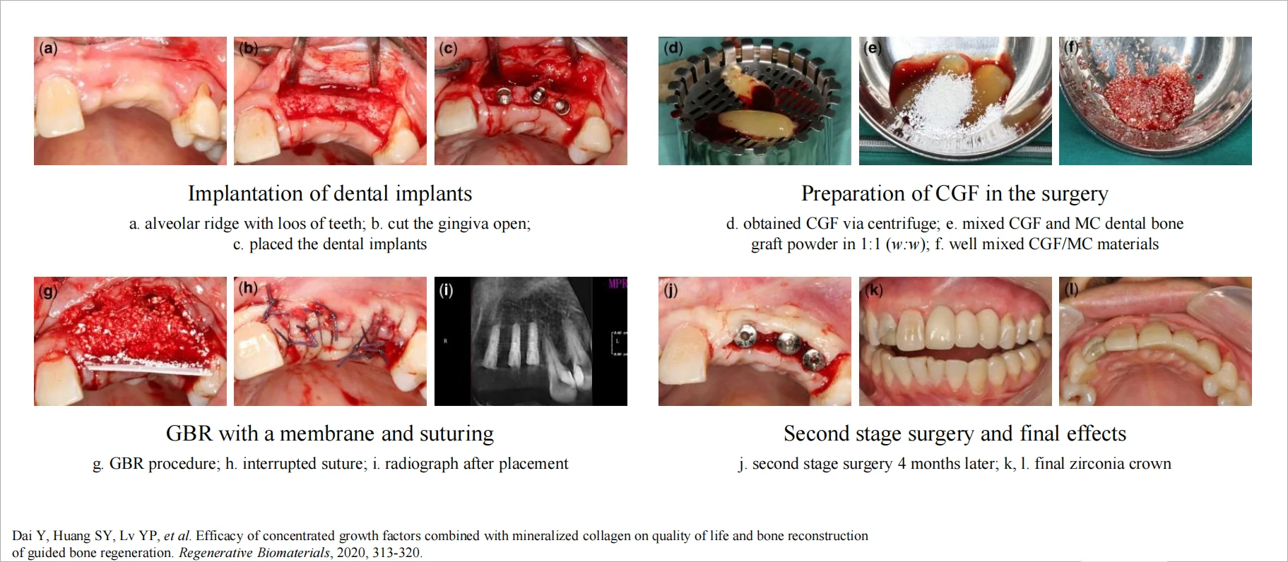 Ossanova Dental Bone Graft Powder - Collagen & Hydroxyapatite