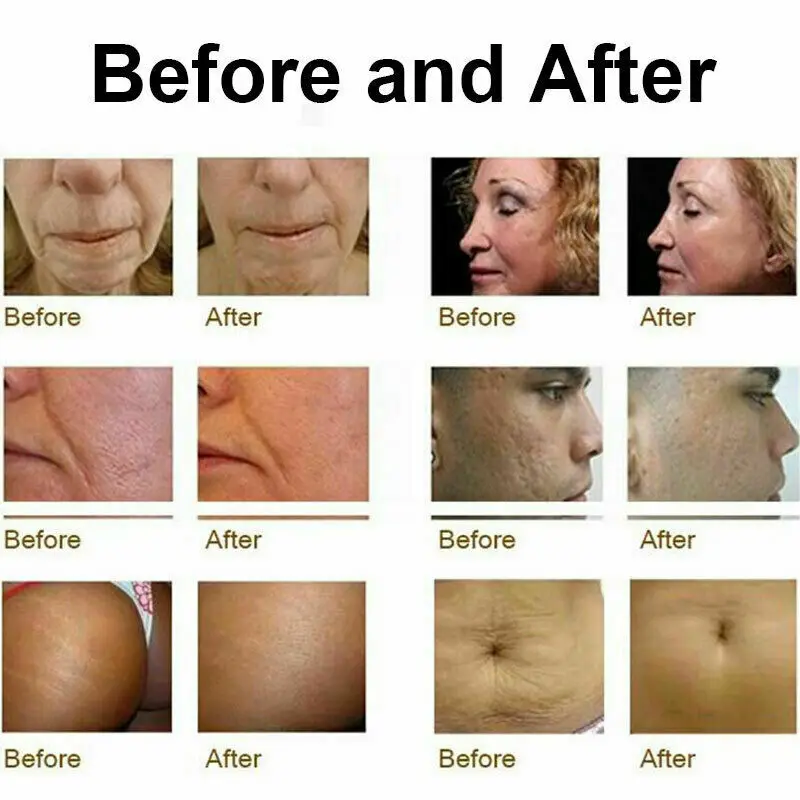 Popular Face Lifing Machine Portable Rf Machine 10/25/64/nano ...