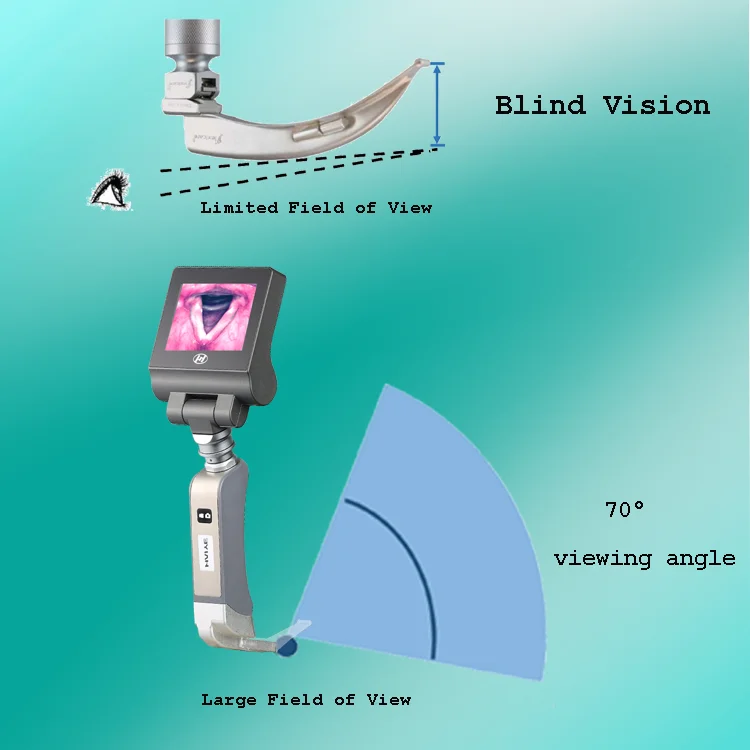 Hospital Surgical Instruments Disposable Video Laryngoscope Endoscope ...