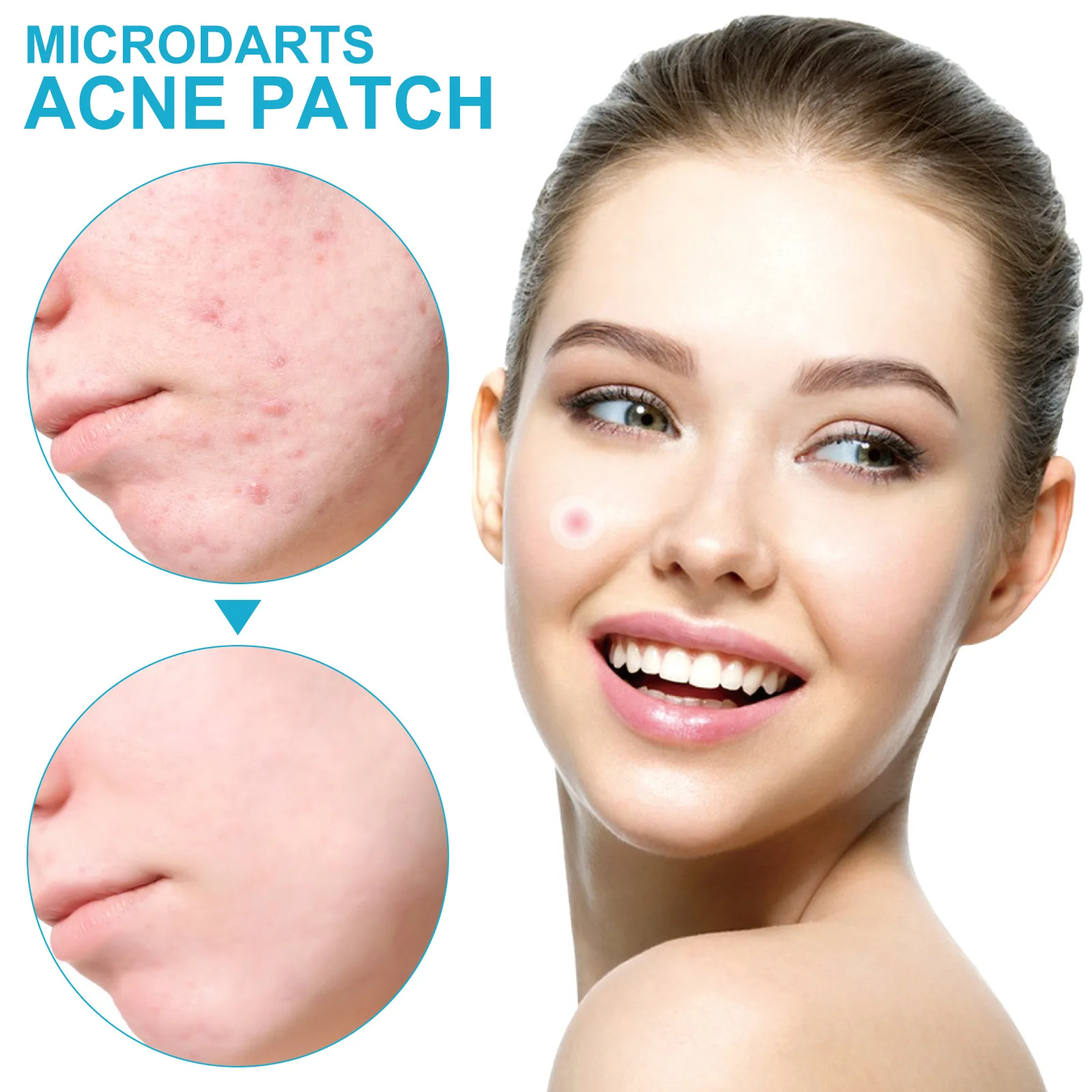 Microneedle Hyaluronic Acid Microneedle Acne Paste Dilute Acne Imprint ...
