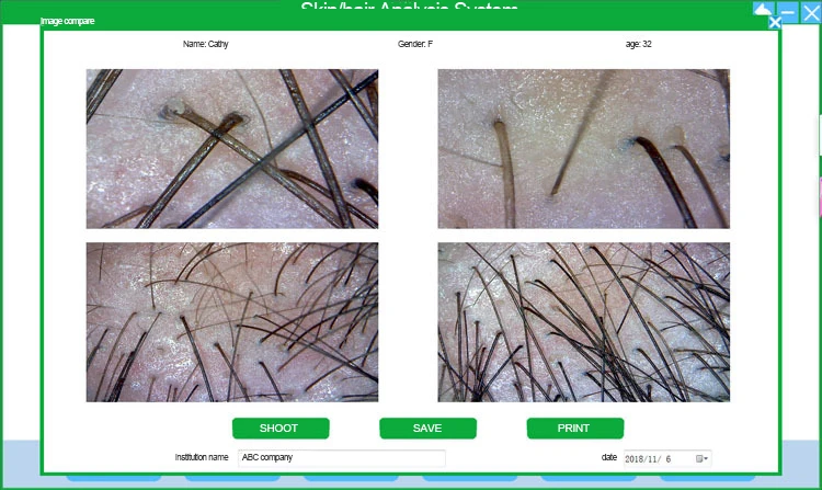Pc Connection Scalp Forllicle Analyzer Giving Report And Recommend ...