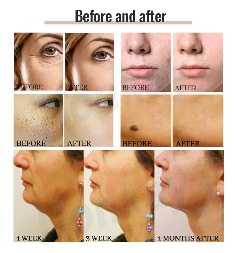 Korea Medico Jet Cold Plasma Fibroblast Device Mole Removal Skin ...