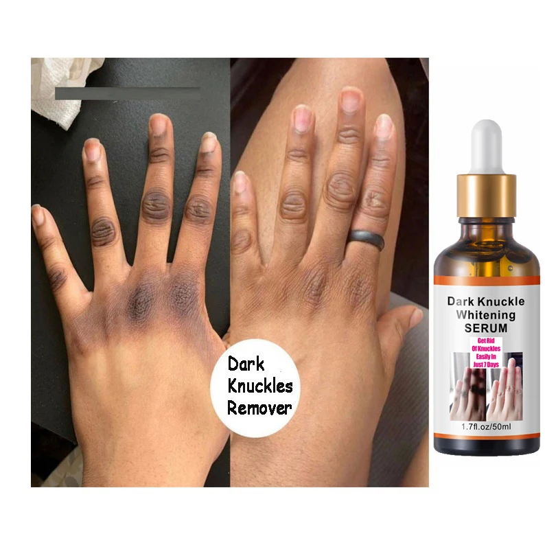 Get Rid of Dark Knuckles in 7 Days - Whitening Serum for Hands, Elbows ...
