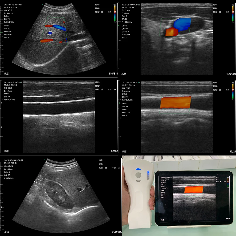 Suresult Electric Color Doppler Obstetric Wireless Ultrasound Monitor ...