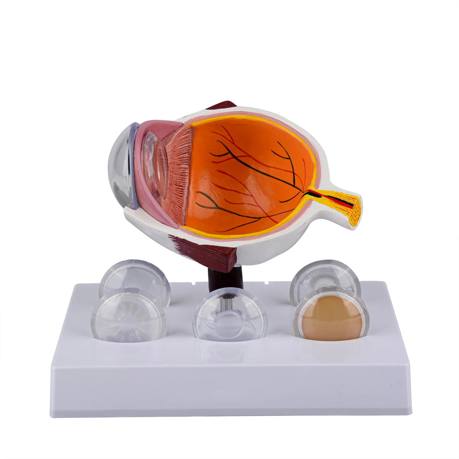 Human Ocular Lesion Model Glaucoma,Cataract Model Eye Enlargement Model ...