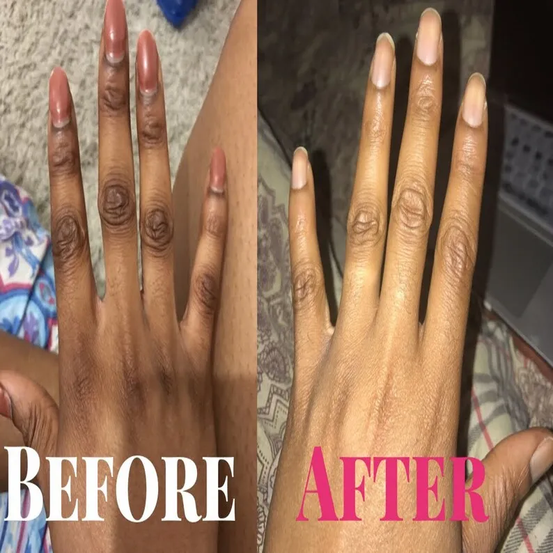 Get Rid of Dark Knuckles in 7 Days - Whitening Serum for Hands, Elbows ...