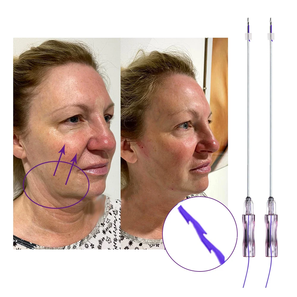 Stronger Lifting Face Hilos Thread Tensores Molding Cog Blunt W 18g ...