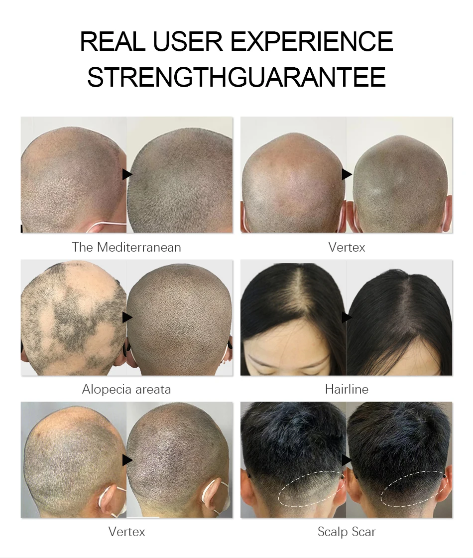 Micropigmentation High Quality Scalp Micropigmentation Smp Tattoo Skin ...