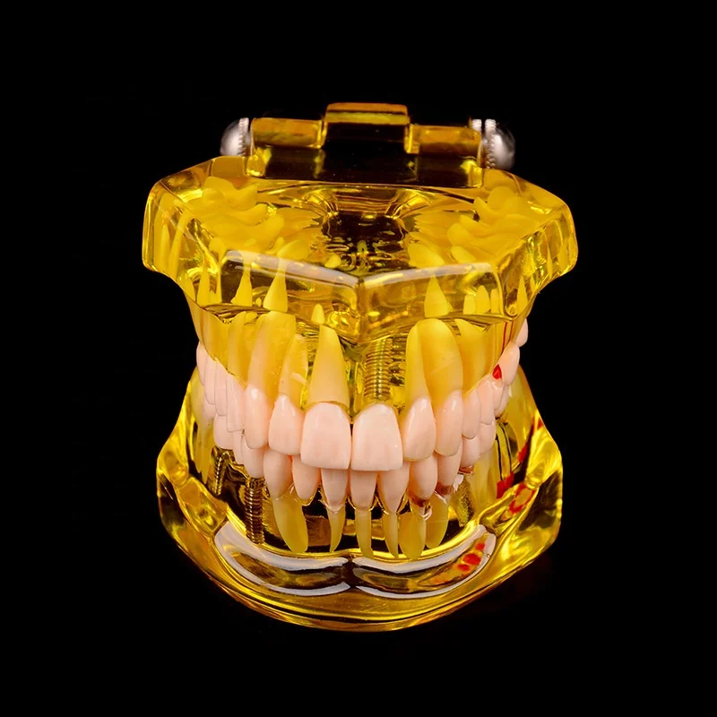 Oral Bridge Model Movable Tooth Model Removable Implant Model - Buy ...