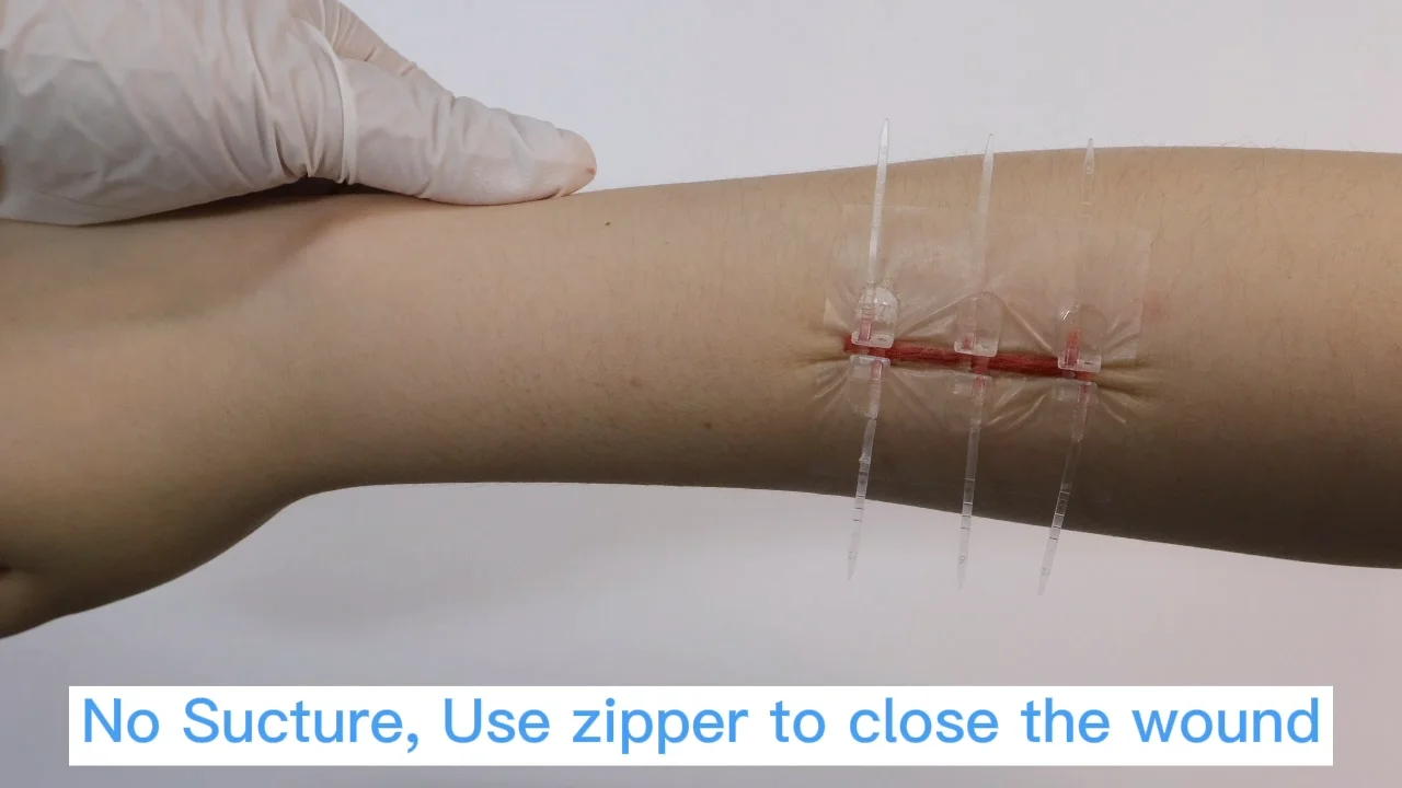 Trummed Medical Zip Stitches Non-invasive Surgical Zip Stitch Without ...