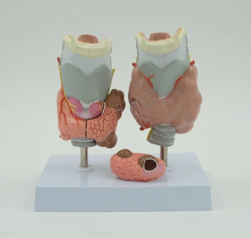 Medical Teaching Thyroid Pathology Model Endocrine Medicine Anatomy ...