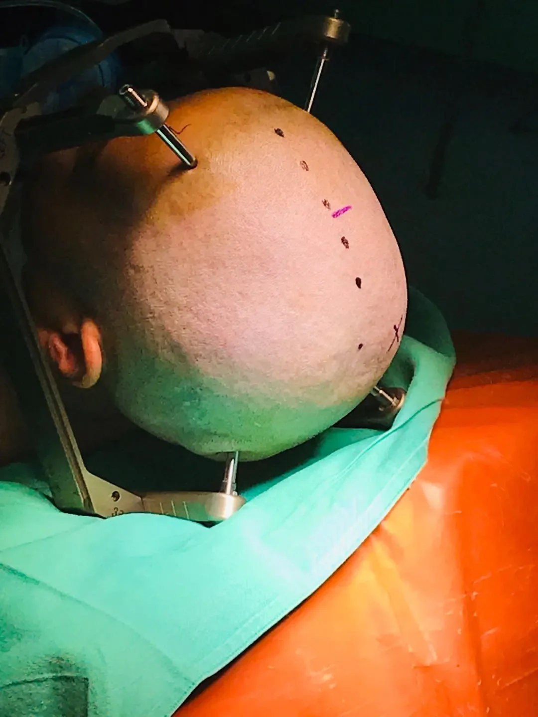 Brain Surgery Surgical Instruments Neurosurgery Brain Stereotaxic Head ...