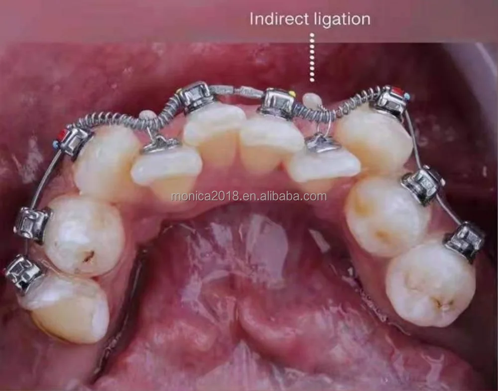 Dental Orthodontics Small Component Teeth Orthodontic Dental Products ...