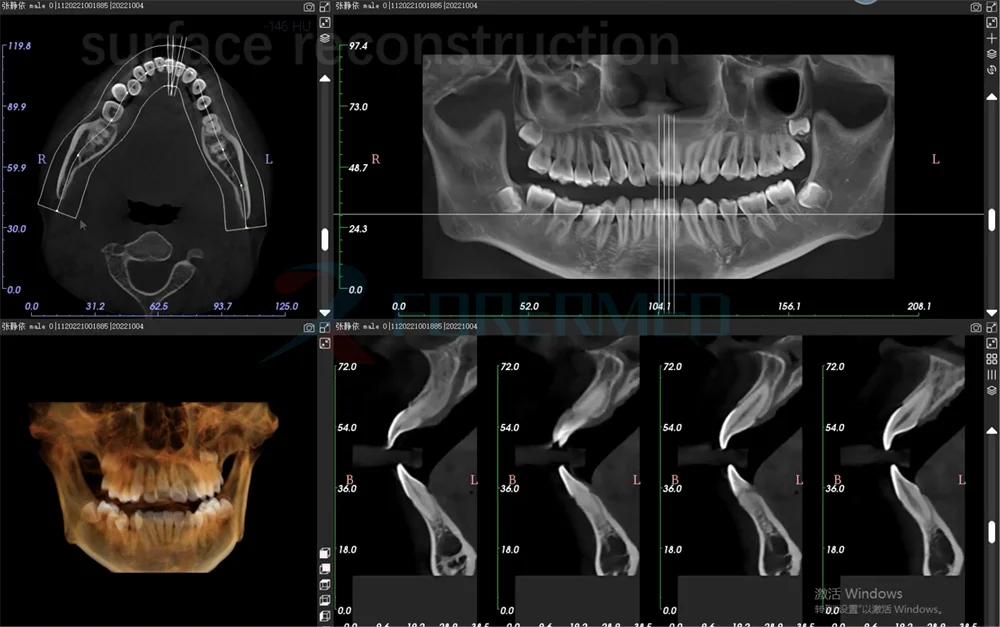 4 In 1 Digital Cbct Dental X Ray M2 Fov Cone Beam Ai Computed ...