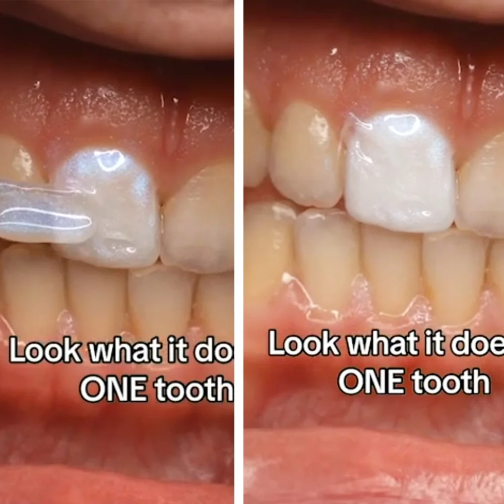 Professional Custom Dental Smilekit - Home Teeth Whitening