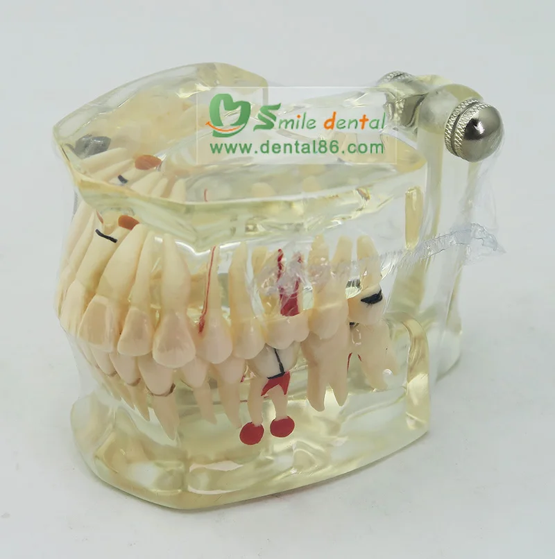 Pathology Teeth Model Dental Study Model| Alibaba.com