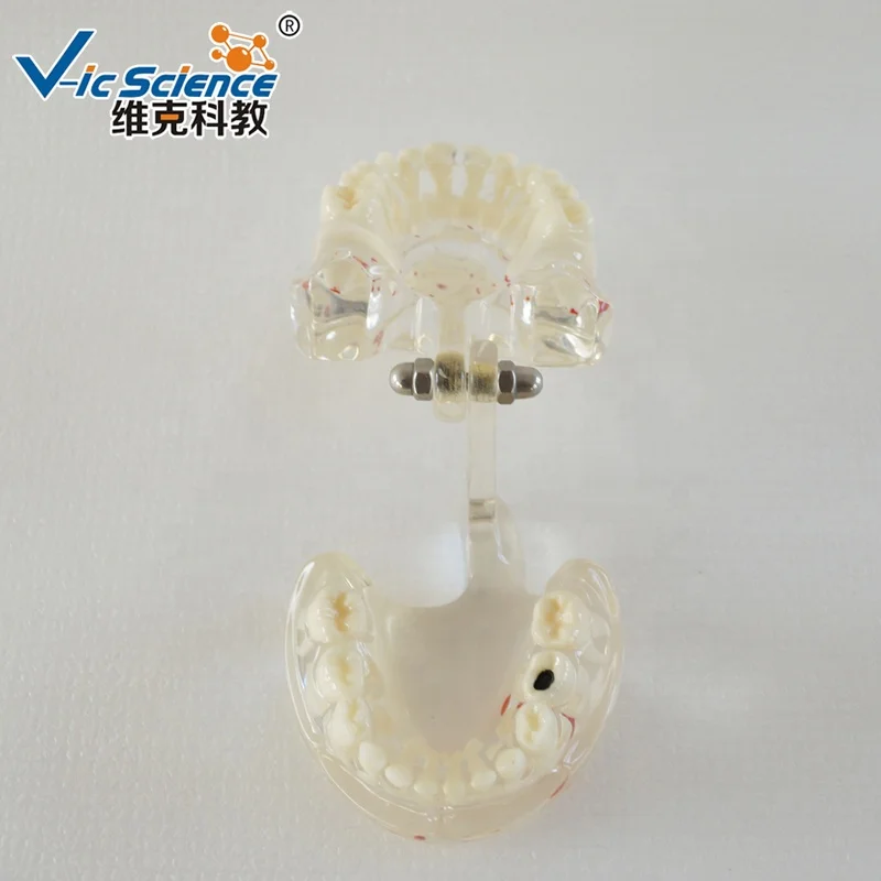 Anatomical Model Of Deciduous Permanent Teeth With Alternating Caries ...