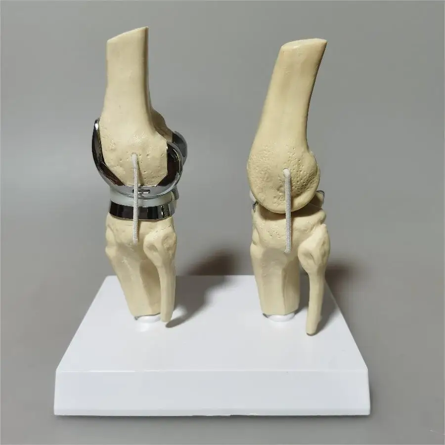 Artificial Knee Joint Replacement Teaching Display Model Human Knee ...
