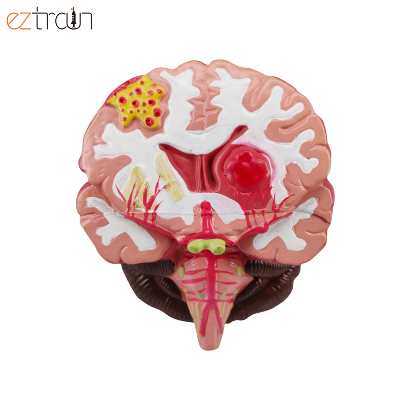 Human Brain Anatomy Model with Pathologies, Stroke,Subdural Hematoma ...