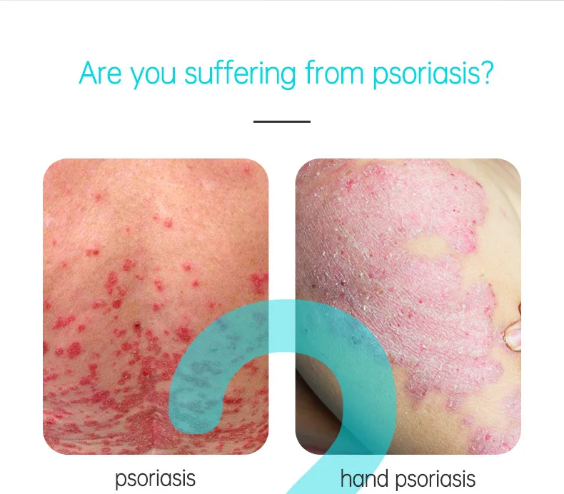 Skin Pruritus Ointment Skin Ringworm Wang Ointment Dispel Psoriasis ...